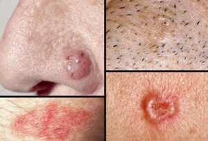 Basal Cell Carcinoma (BCC): Types, Causes, and Treatment Options - Dr ...